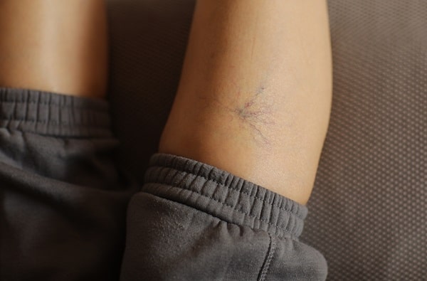 Signs Of Muscle Cramps You Should Get Checked Out