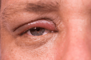 What Causes Crusty Eyes When You Wake Up Health Tips Now What Causes Crusty Eyes When You Wake Up Health Tips Now
