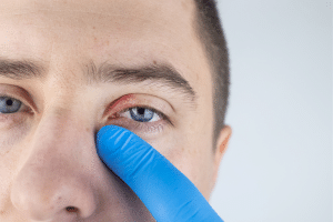 What Causes Crusty Eyes When You Wake Up | Health Tips Now